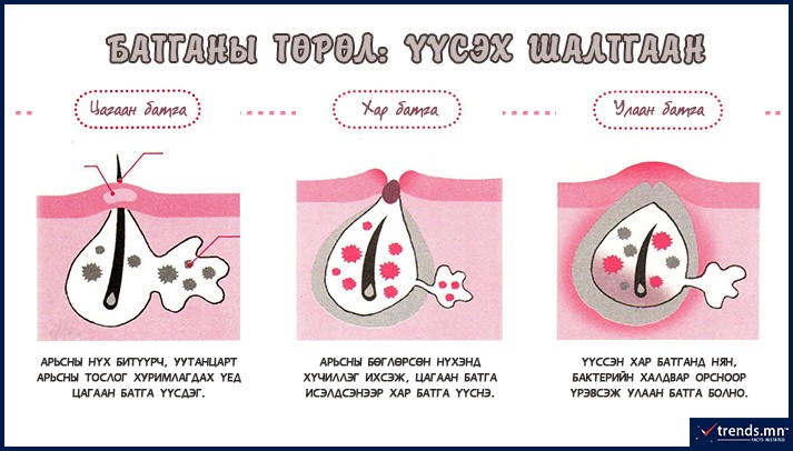 Насанд хүрсэн хүний батга түүний шалтгаан Trends Mn
